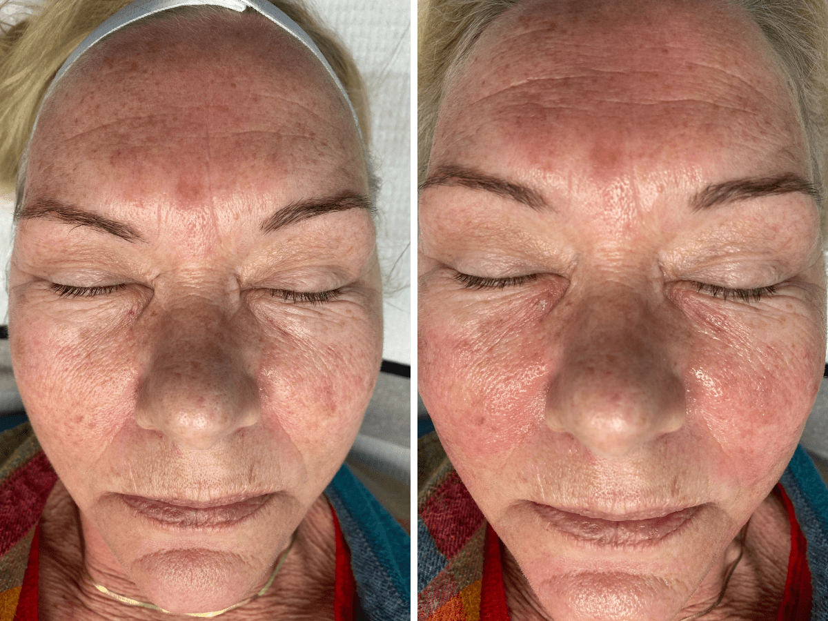 IPL / Intense Pulsed Light - Meridiem Dermspa